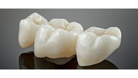 🦷 Teilkrone in der Zahnmedizin: Definition und Anwendung